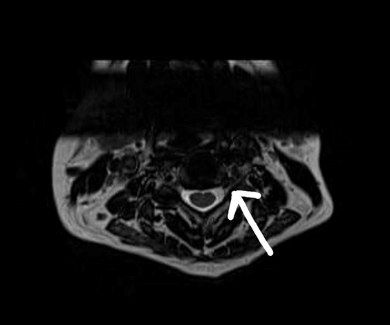 Cervical spondylosis mimicking cardiac angina - Journal of Case Reports ...