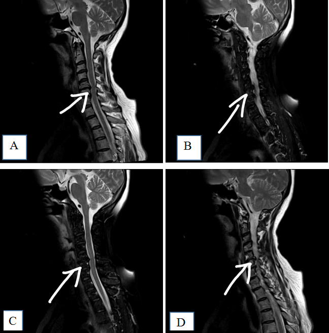 Cervical spondylosis mimicking cardiac angina - Journal of Case Reports ...
